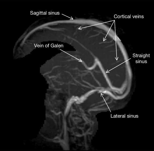 MRV Medical Abbreviation: What It Means - Analgesia