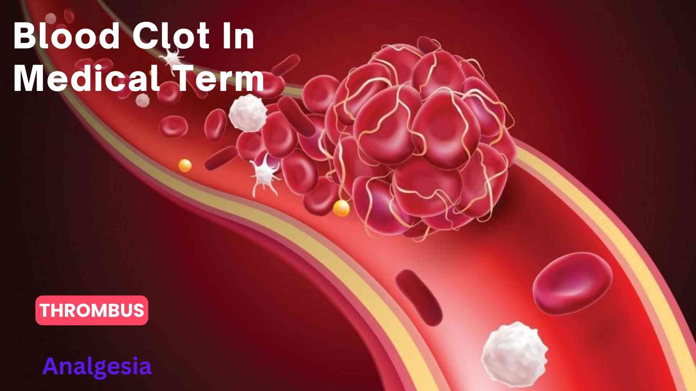 Blood Clot | What is it? - Analgesia