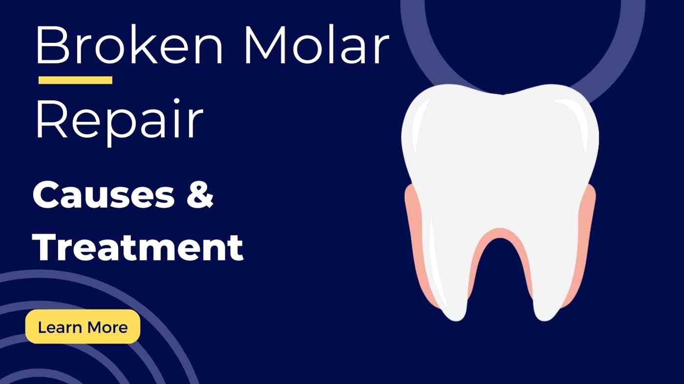 Broken Molar Repair: Causes, Treatment Options, & Recovery